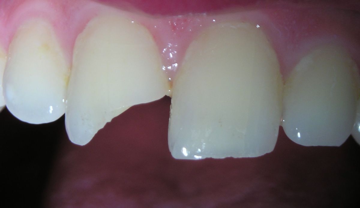 Što učiniti kad zub pukne? – ordinacije protetike dentalne medicine